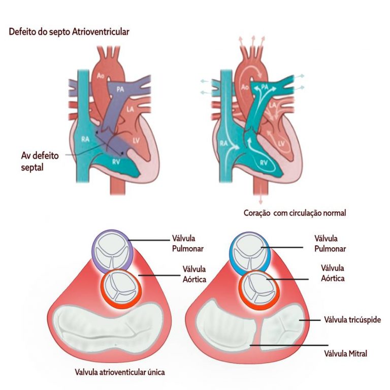 Defeito do Septo Atrioventricular - Anvily