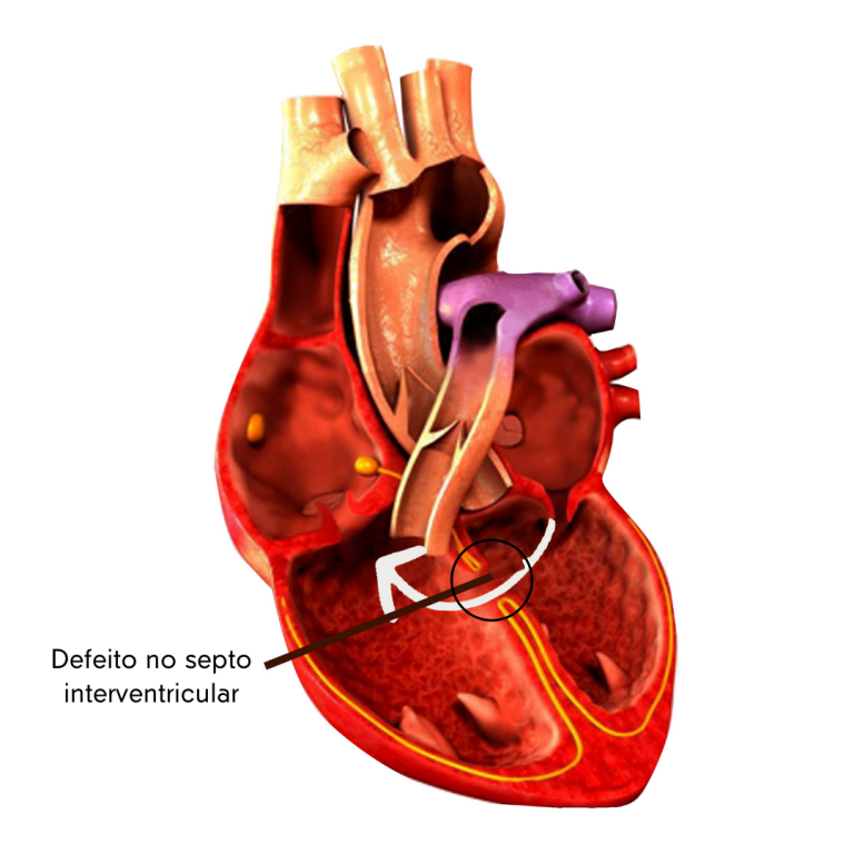 Comunicação Interventricular - Anvily